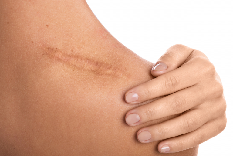 Secrets of Your Scars - Being In Balance Physical Therapy